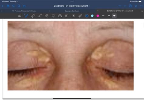 Eye Condition Pictures Flashcards Quizlet