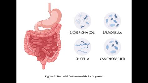 Bacterial Gastroenteritis Definition Causes Symptoms Diagnosis