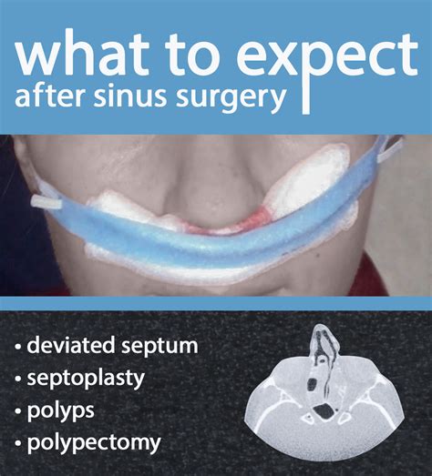 An Apel A Day What To Expect After A Sinus Surgery Deviatedseptum