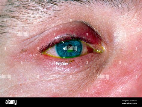 Corneal Abrasion Stained With Fluorescein Dye The Cornea Is That