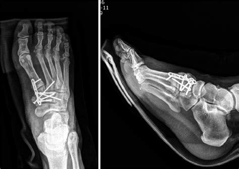 Cuneiform Bone Fracture