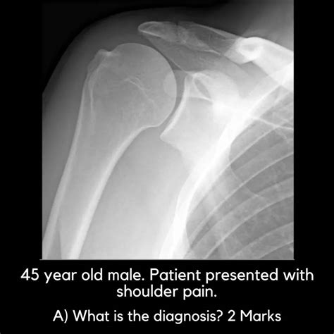 An Os Acromiale Is An Unfused Orthopaedic Tutorials