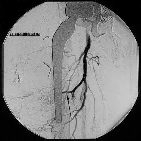 Dsa Following Coil Embolization Arrow Using Three Vortx 35 Fibred