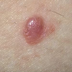 Nodular Malignant Melanoma Skin Lesions