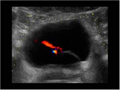 Urinary Tract And Male Reproductive System 22 Bladder Case 223 Miscellaneous Bladder And