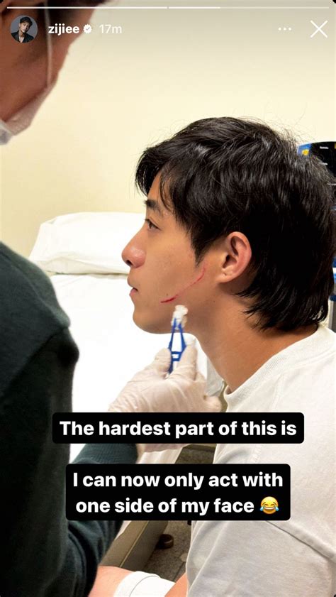 “i Think I Look Quite Badass Now” Zong Zijie Gets 10cm Cut On His Cheek While Filming New