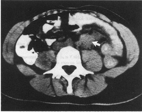 Computerized Tomography Appearance Of Mesenteric Desmoid Download Scientific Diagram