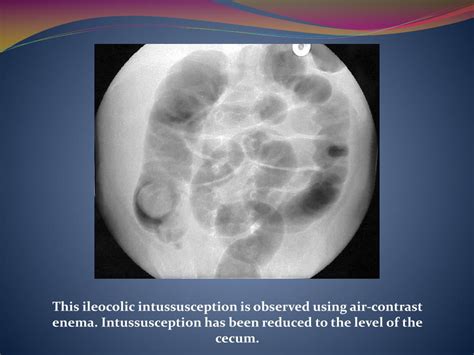 Ppt Intussusception Powerpoint Presentation Free Download Id 1973263