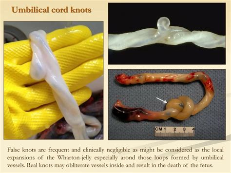 Ppt Formation Of Vessels Intrauterine Circulation Twinning And