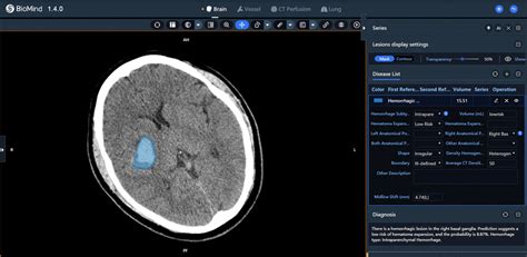 The Illustration Of Ai Software User Interface Using Initial Ct Scan
