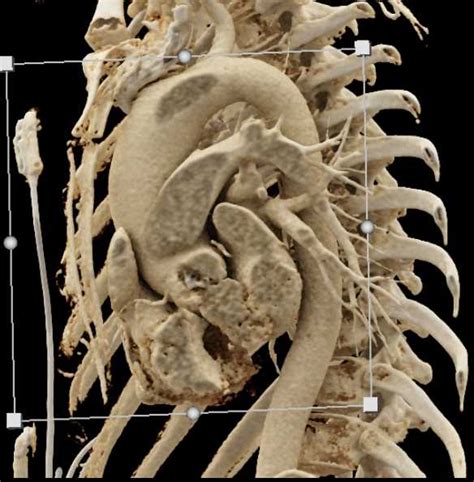 Good Visualization Of The Left Atrial Appendage Cardiac Case Studies