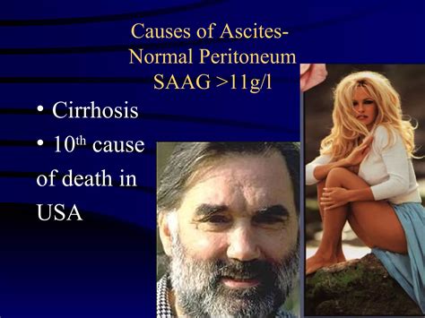 Principles Of Management Of Ascites Combined Ppt