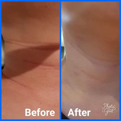 Remove Get Rid Deep Lines Wrinkles Sydney HIFU Skin Tightening
