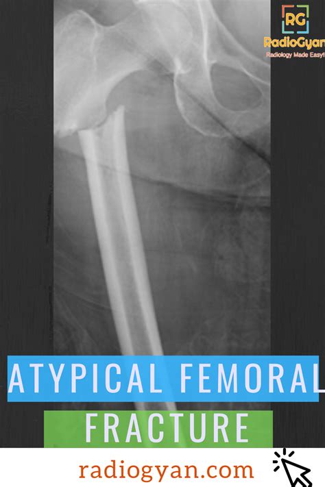 Atypical Femoral Fracture Imaging And Clinical Features Explained