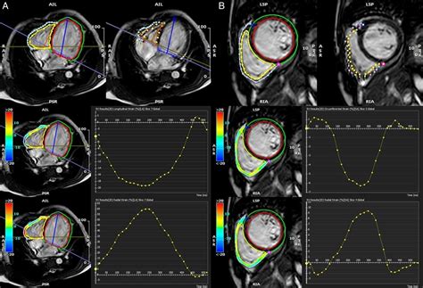 Right Ventricular Strain Analysis By Tissue Tracking Cardiac Journal Of Thoracic Imaging