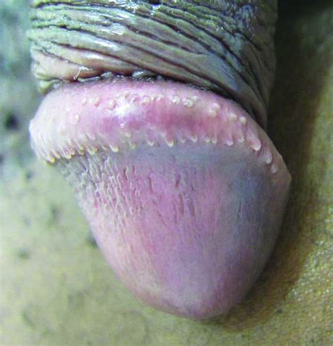 Pearly Penile Papules On Head