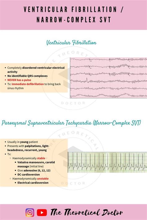 Understanding Ventricular Fibrillation And Narrow Complex Svt