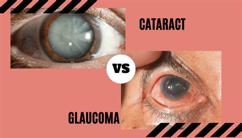 Glaucoma Vs Cataract Whats The Difference Laxmi Eye Hospital