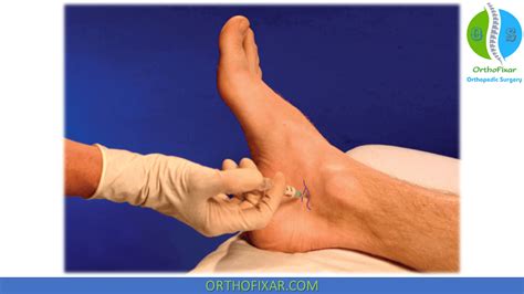Subtalar Joint Injection Easily Step By Step Orthofixar