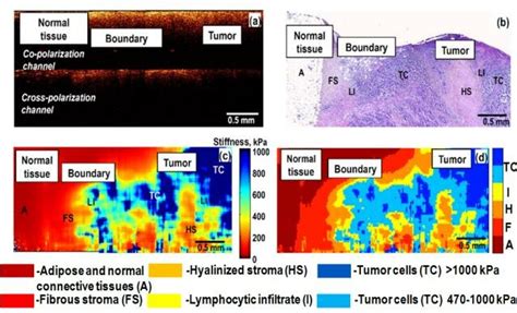 Example Of Segmentation Of Morphological Components Of Breast Cancer Download Scientific