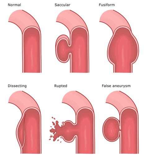 Saccular And Fusiform Aneurysms Types Risks And Treatment Options Supreme Vascular And