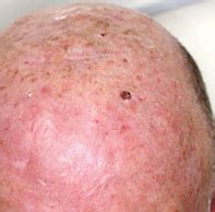 A Rapidly Growing Nodule On The Scalp Medicine Today