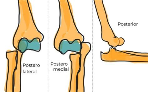 Elbow Dislocation Anatomy Classification Treatment Simplified