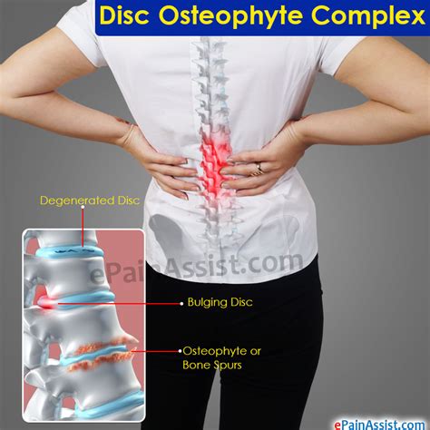 Disc Osteophyte Complex Treatment Symptoms Causes
