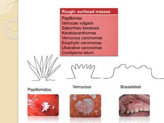 Oral Exophytic Lesions Pptx