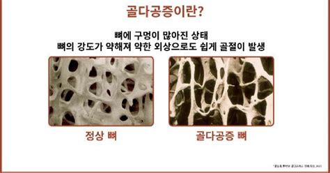 노인 골절 부르는 골다공증 꾸준한 치료가 가장 중요