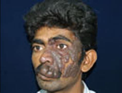 Vascular Malformation Hyderabad Cleft Society