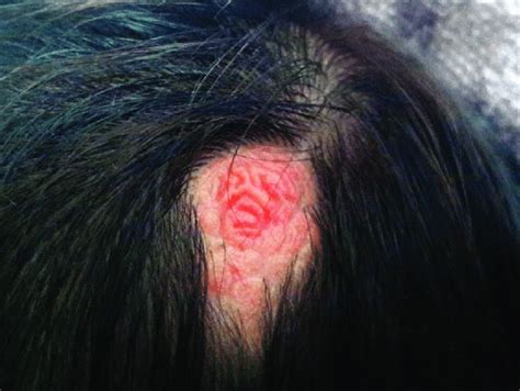 Cerebriform Nevus Sebaceous A Firm Well Defined Pinkorange Coloured Download Scientific