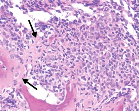Imaging Characteristics Of Primary Osteosarcoma Nonconventional