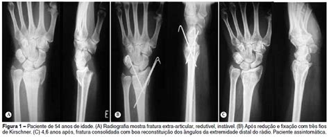 Scielo Brasil Resultados Funcionais E Radiológicos A Longo Prazo Da