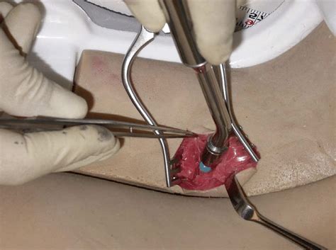 Surgical Detection Of Radioactive Hot And Blue Sentinel Node Download Scientific Diagram