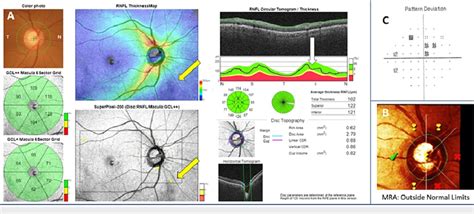 A 65 Year Old Female With Primary Open Angle Glaucoma In The Right Eye Download Scientific