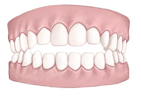 Open Bite Central Park West Dentistry