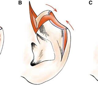 Temporal Releasing Incision And Elevation Of The Temporal Scalp Flap Download Scientific Diagram