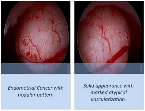 Hysteroscopy Endometrial Cancer