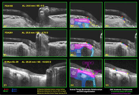 Oct Optic Nerve Head Morphology In Myopia Iv Neural Canal Scleral