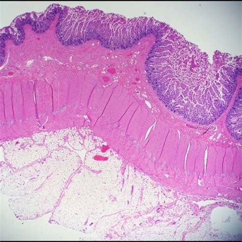 Ileocolic Resection Showing An Edematous Terminal Ileum With Download Scientific Diagram