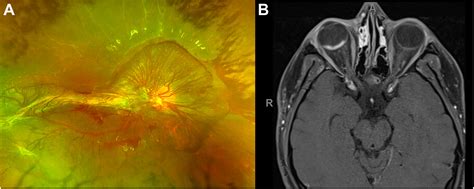 Optic Nerve Neovascularization In Radiation Retinopathy Seen On Magnetic Resonance Imaging