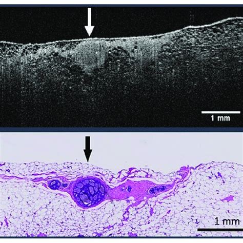 Wf Oct Image Of Breast Tissue Top And The Corresponding Digital