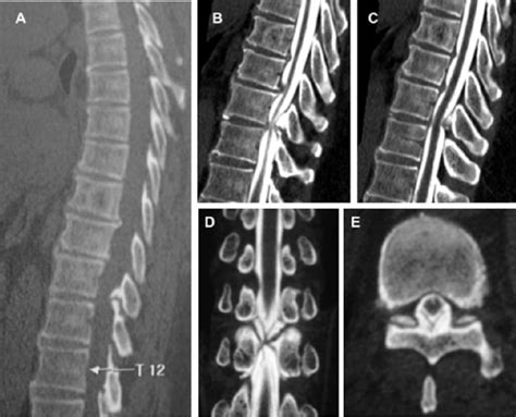 A Computed Tomography Ct Scan Showing Ossification Of The