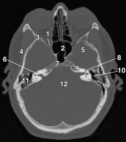 Cranial Bone Anatomy Ct Axial