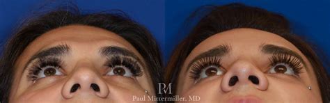 Type 3 Brow Bone Setback Before And After Photos 220727