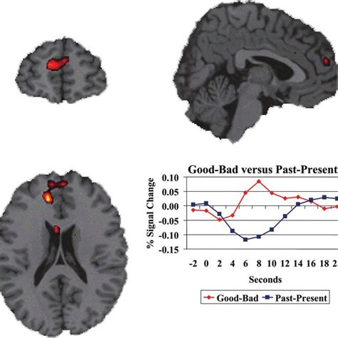 Random Effects Contrast Map Showing Activation P 001 For The