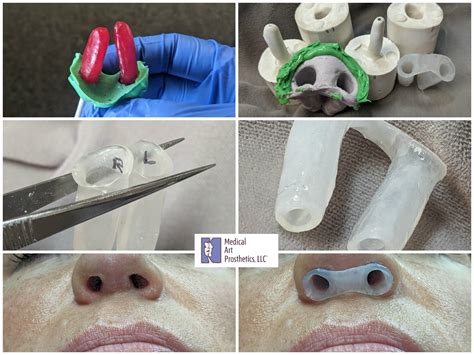 Custom Silicone Nasal Stents Are Medical Art Prosthetics