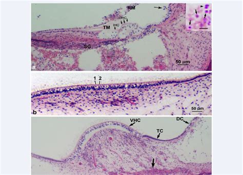 Right Temporal Bone Of A 2 Month 24 Day Old Girl With Cmv Infection A