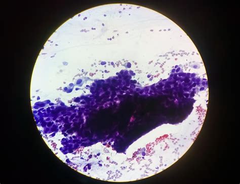 Premium Photo Microscopic Image Of Histopathological Slide Showing Carcinoma